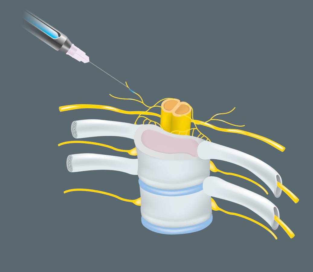 Intravascular Uptake of Nerve Block - California Anesthesia Professionals